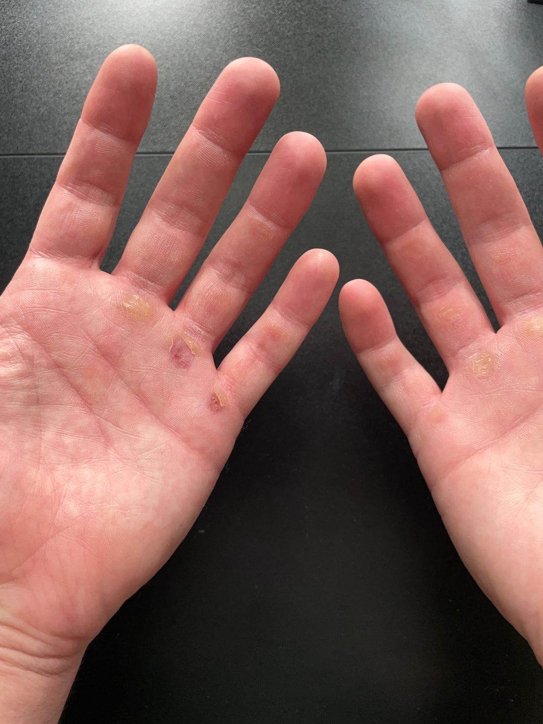 Tape to Prevent Calluses – Shadowz Grips